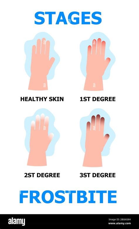 First Degree Frostnip