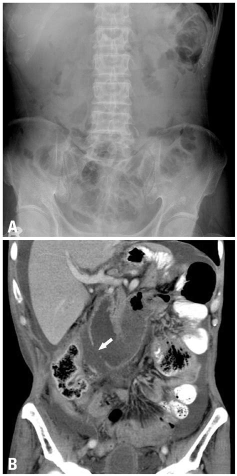Afferent Loop Obstruction In A 58 Year Old Man After Roux En Y Download Scientific Diagram