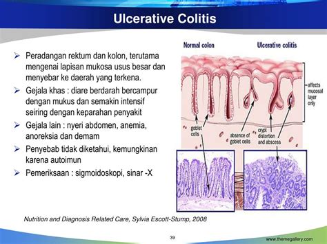 Ulcerative Colitis Anemia Ulcerative Colitis And Anemia Understanding The Connection Symptoms