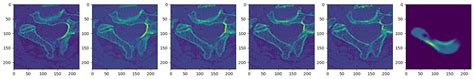 github bishnarender rsna 2022 cervical fracture detection detection