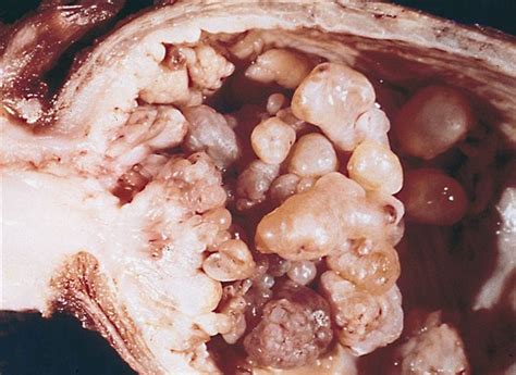 Pathology Outlines Embryonal Rhabdomyosarcoma