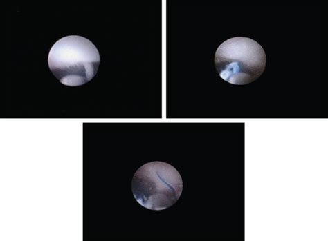 Diagnostic Ureteroscopy Abdominal Key