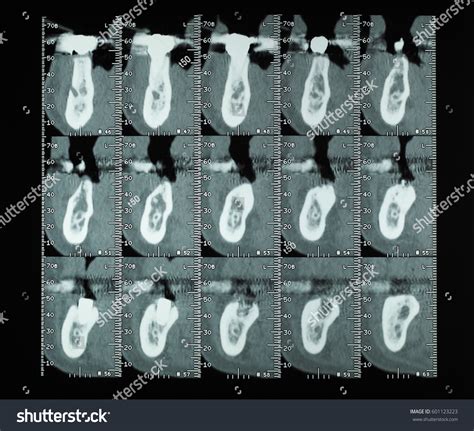 Ct Scan Aka Cat Scan Cross Stock Photo Shutterstock