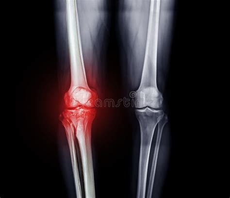 X Ray Image Of Both Knee Ap View For Diagnostic Osteoarthritis Or Knee