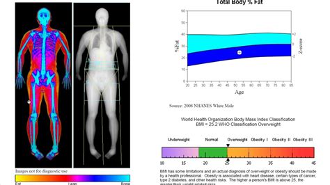 Dxa Scan Results