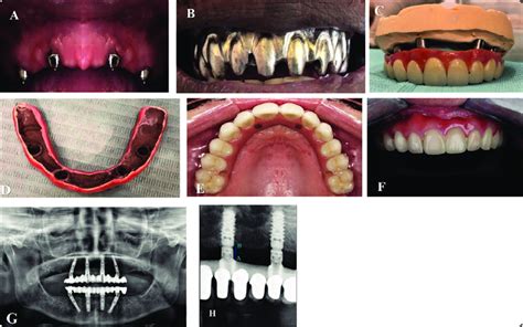 All On Four Maxillary Hybrid Prosthesis Hp Group A Tightened