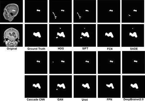 Comparison Of The Output Of Deepbrainet20 With Other Brain Tumor Download Scientific Diagram