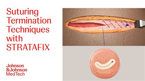 Simple Sutures Termination Technique Using Stratafix Symmetric Jandj Medtech Youtube