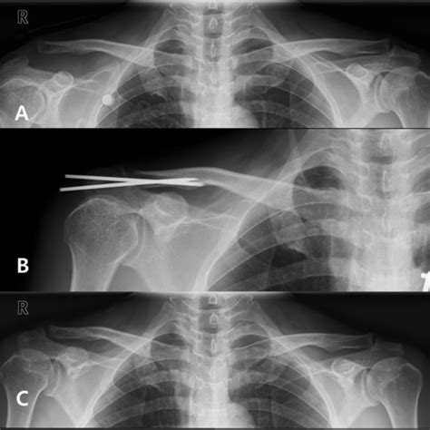 A Type V Ac Dislocation By Rockwood Classification B Ac Joint Download Scientific Diagram