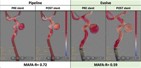 Comparison Of Intra Aneurysmal Flow Modification Using Optical Flow