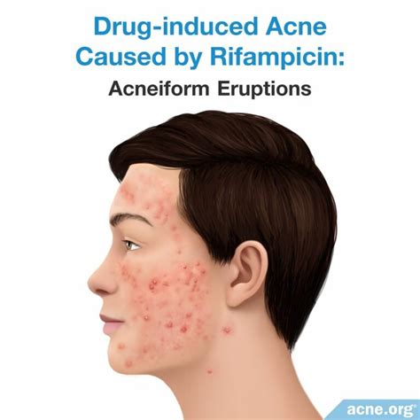 Medications That Cause Acne Common Culprits Explained