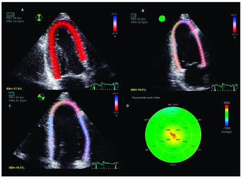 Measurement Of Myocardial Work In An Individual Patient The Figure Download Scientific Diagram