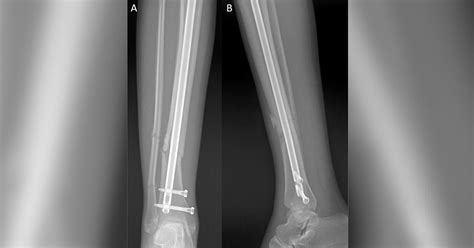 Distal Tibia Fracture
