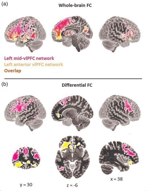 A Whole‐brain Functional Connectivity Fc For Left Mid‐ventrolateral