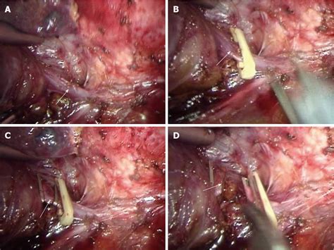 Figure 1 From Laparoscopic Vs Open Left Hepatectomy For Hepatolithiasis Semantic Scholar