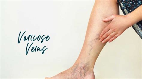 Varicose Veins Causes Symptoms Treatment With Anf Therapy