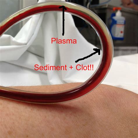 Ecmo Troubleshooting 3 Problems You Need To Recognize Early University Of Maryland