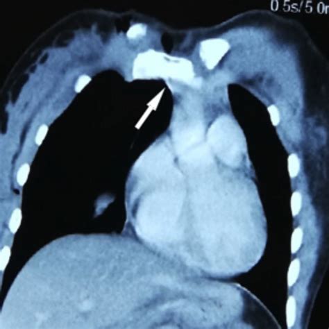 Ct Scan With Contrast Showing Extravasation Of Contrast At The Download Scientific Diagram