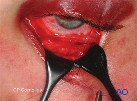 Transconjunctival Approaches