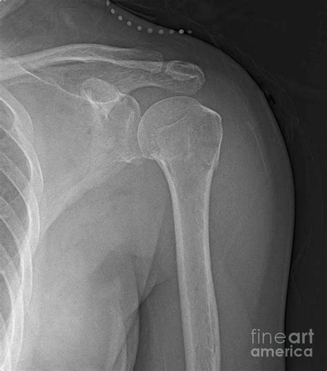 Humerus X Ray