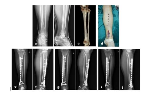 Spiral Fracture Tibia