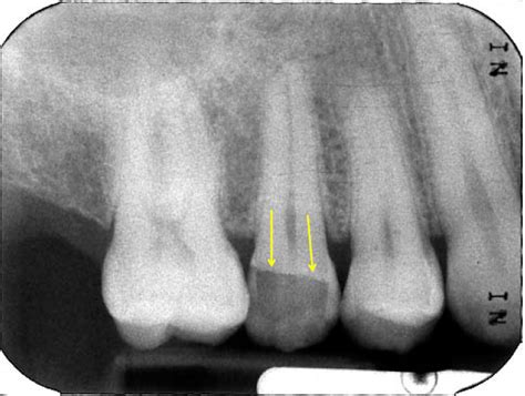 Case Of The Week Coronal Fracture Dr Gs Toothpix