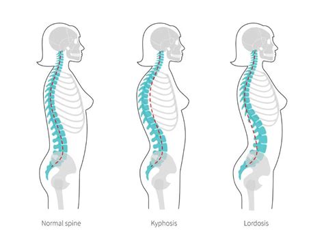 A Guide To Cervical Lordosis Treatment Options
