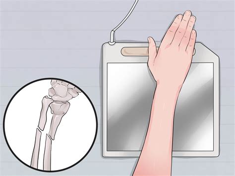 How To Tell The Difference Between A Wrist Sprain And A Wrist Fracture