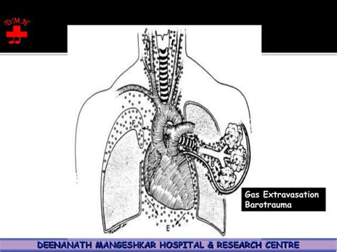 Ards Patho Physiology 1pptx