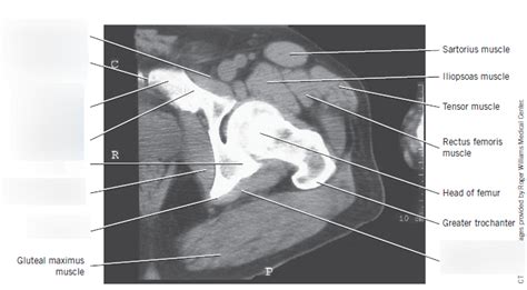 Diagram Of Ct Hip 5 Quizlet