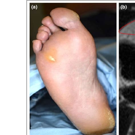 A Focal Keratoderma Predominantly Download Scientific Diagram