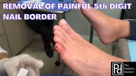 Partial Nail Avulsion W Matrixectomy Of 5th Digit Youtube