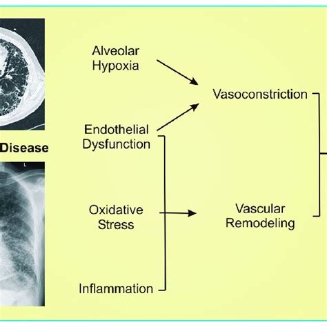 Schematic Representation Of Pathogenesis Of Pulmonary Hypertension In Download Scientific