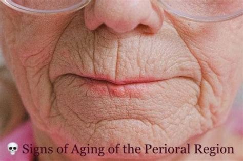 Yousef Nazari On Linkedin 💀 Signs Of Aging Of The Perioral Region 1 Elongation Of The Upper…