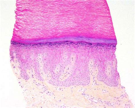 Punctate Keratosis