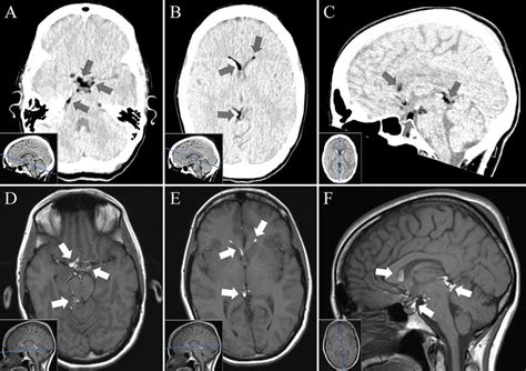 axial a and b and sagittal c cranial ct scans show multifocal download scientific diagram