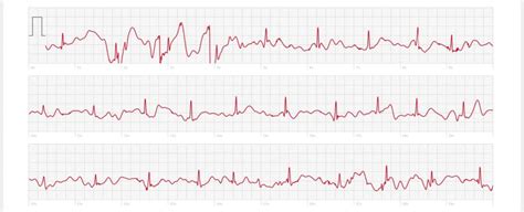 My Watch Is Scaring Me 1st Ever Reading Of Afib But The Next One I