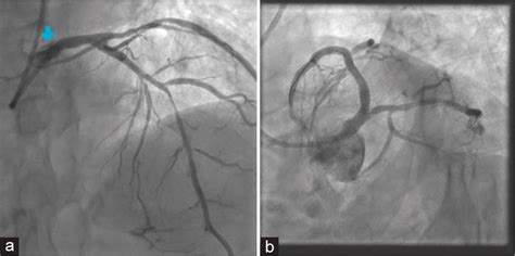Complications Of PCI And Its Management Indian Journal Of Cardiovascular Disease In Women