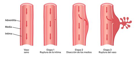 Aortic Dissection Abc Medical Center