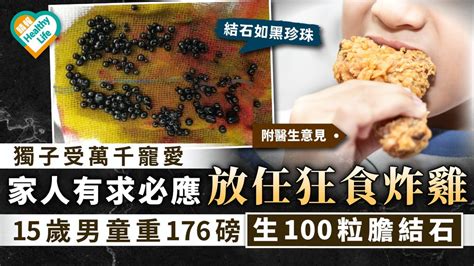 不良飲食獨子受萬千寵愛放任狂食炸雞 15歲男童重176磅生100粒膽結石 晴報 健康 生活健康 D210608