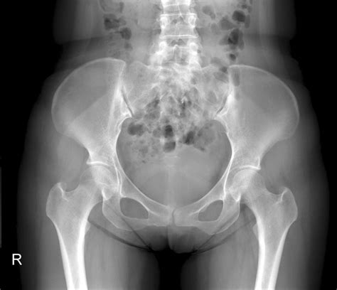 Abnormal Pelvic X Ray Re Prt Acute Destructive Hip Septic Arthritis In