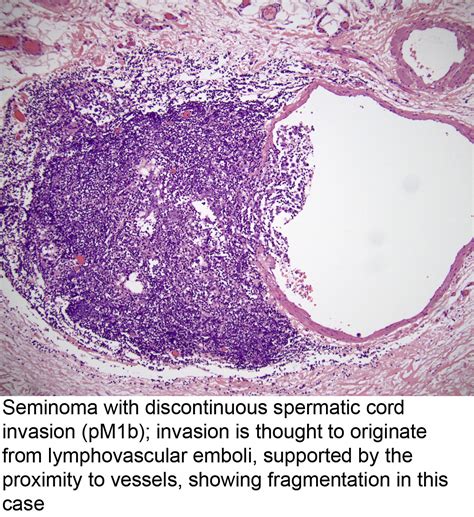 Pathology Outlines Staging