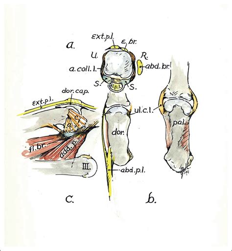 Thumb Metacarpophalangeal Joint Ulnar Collateral Ligament In Jaaos