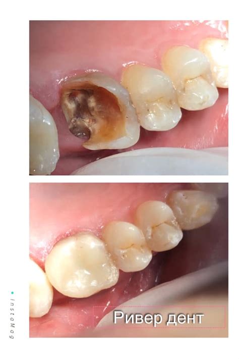 River Dent Гэр бүлийн шүдний эмнэлэг 🌟Ажлын хэсгээс 🔸Сувгийн эмчилгээ өмнө нь хийлгэсэн