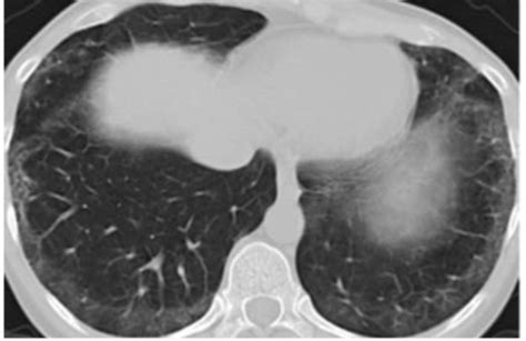 Restrictive Pulmonary Disease Flashcards Quizlet
