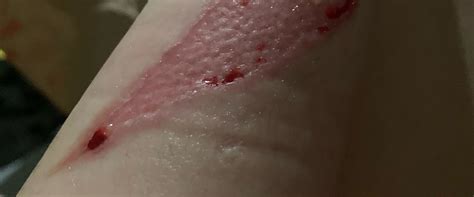 Expert Tips For Treating 2nd Degree Burns