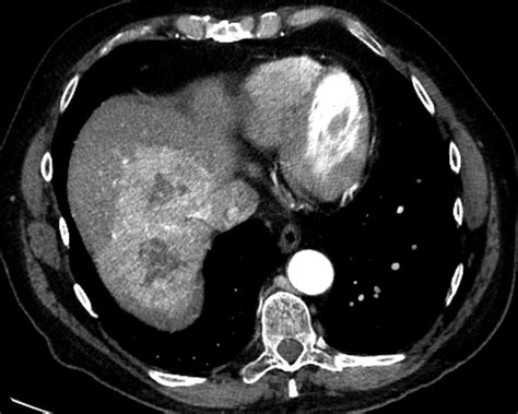 Liver Atlas Diagnosis Metastasis Renal Cell Cancer
