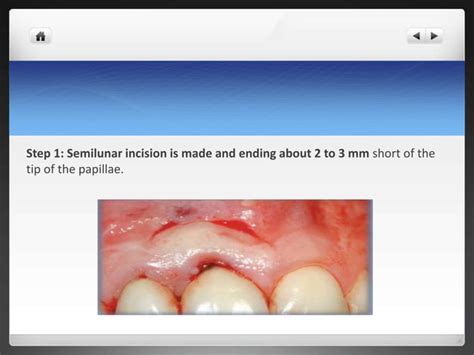 ROOT COVERAGE PROCEDURES PPTX