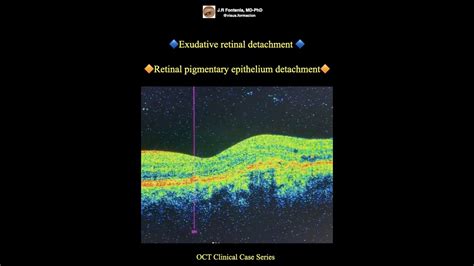 Retinal Detachment Oct