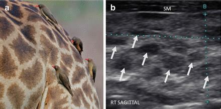 Diffuse Thyroid Disease Dtd And Thyroiditis Radiology Key